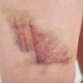 Determining Aging of a Bruise on Autopsy - Godoy Medical Forensics